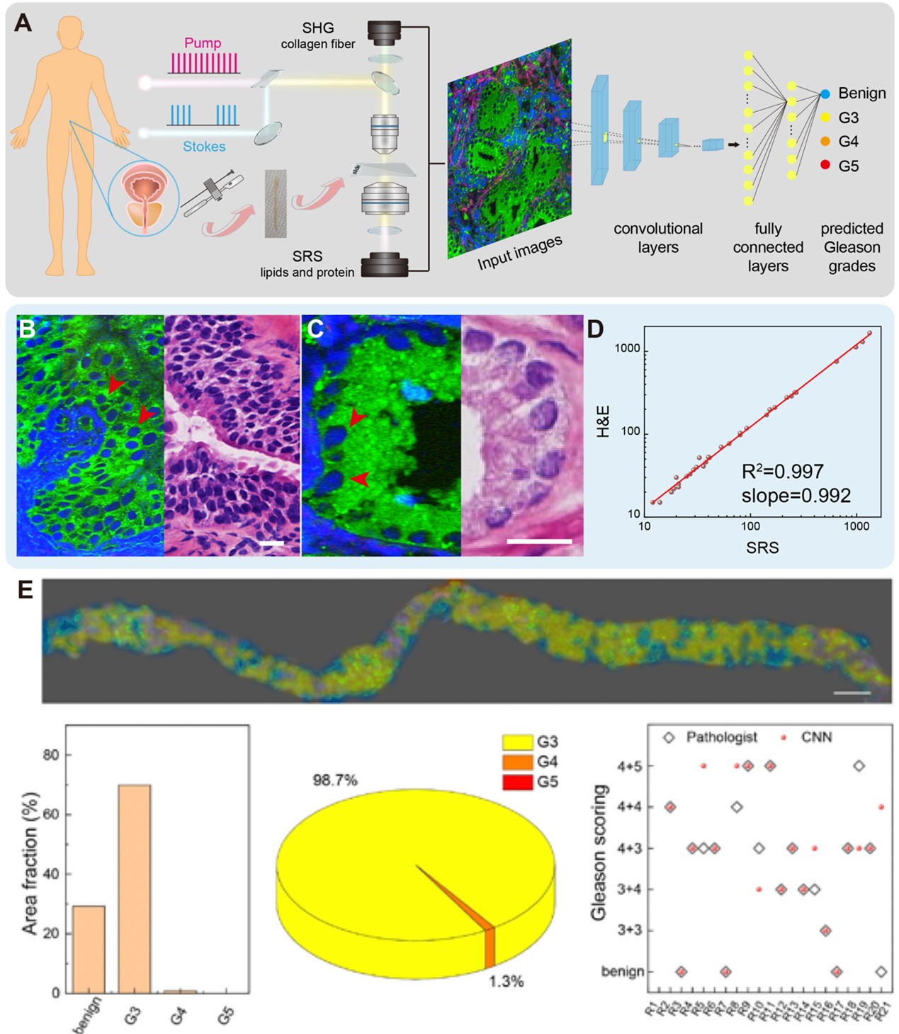 季敏标课题组合作实现前列腺癌穿刺活检的快速智能分级诊断